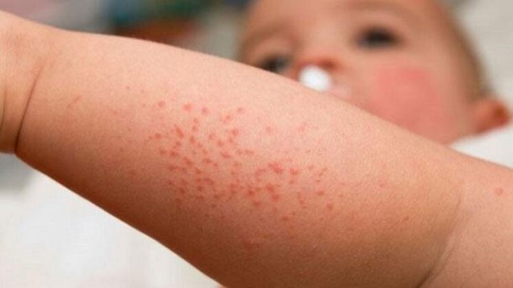 Mách mẹ 13 cách trị rôm sảy cho bé cực hiệu quả áp dụng ngay ...